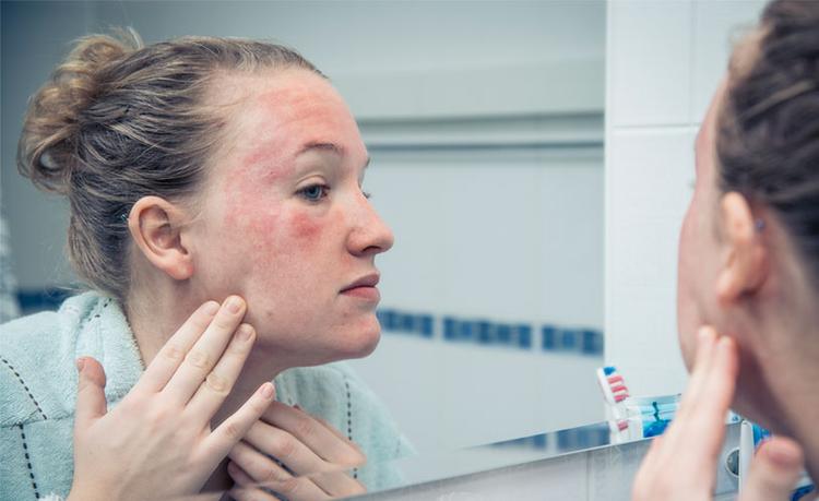 Finacea Gel (Azelaic Acid) Treatment for Rosacea | Pharmacy2U